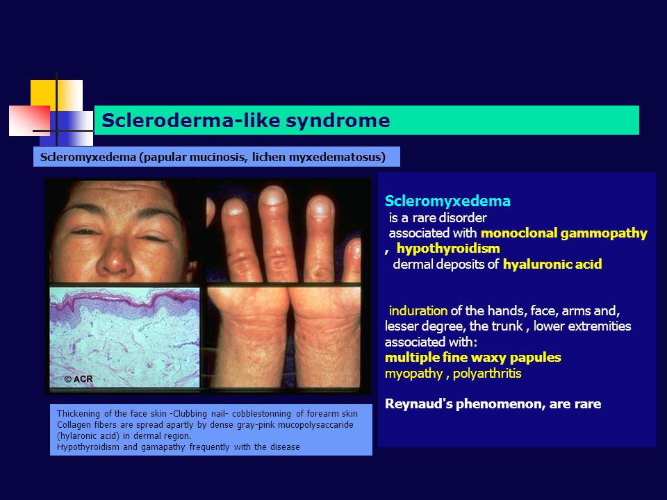 Scleromyxedema Path