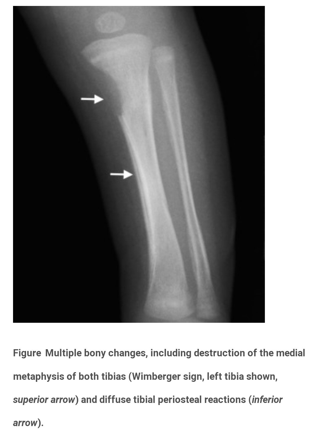 Congenital Syphilis Xray