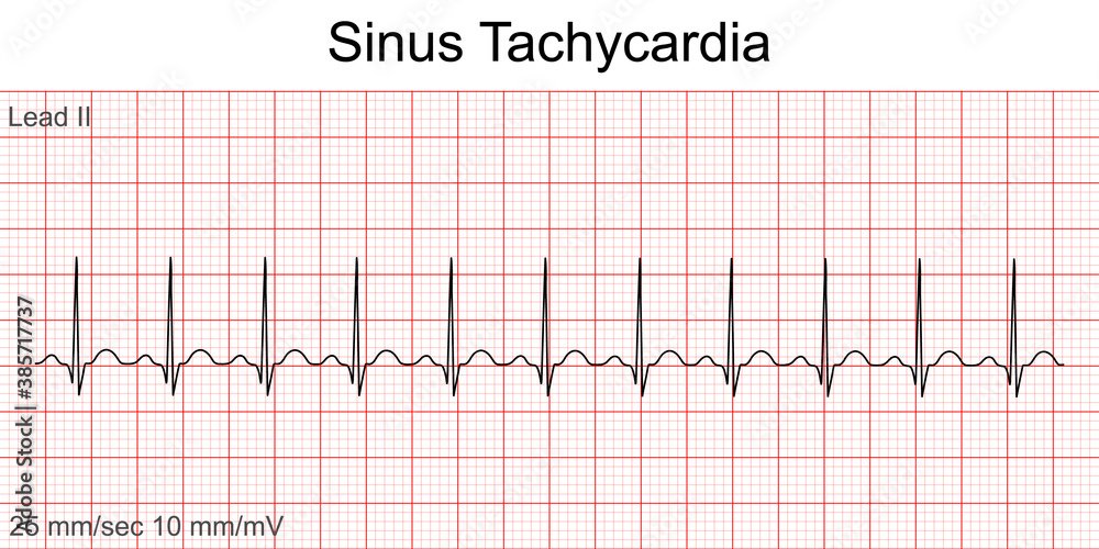 Pediatric tachycardia. 🔴If sinus tachycardia: -try to identify the ...