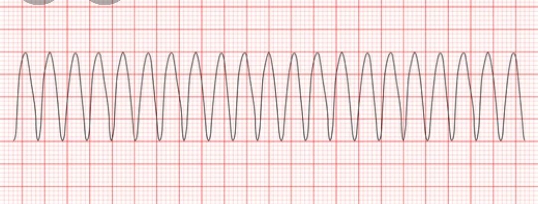 Pediatric tachycardia. 🔴If sinus tachycardia: -try to identify the ...