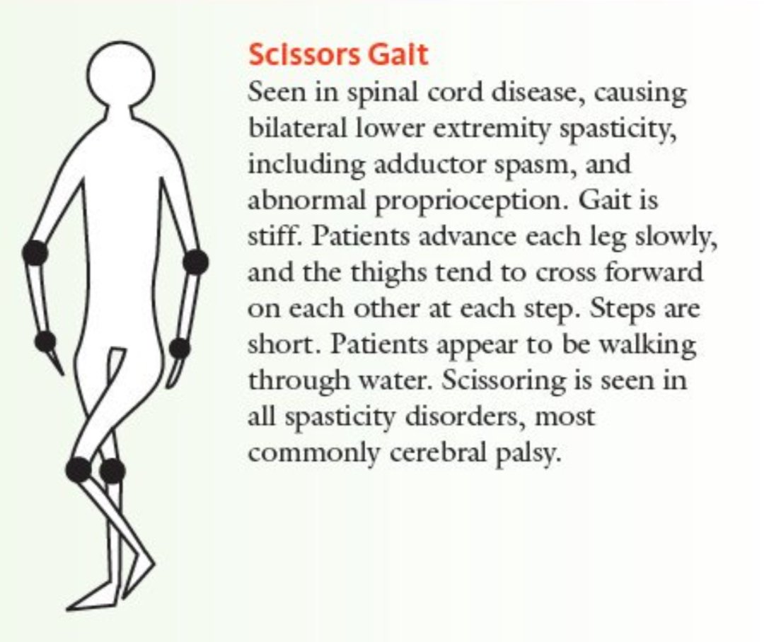 Circumduction Gait