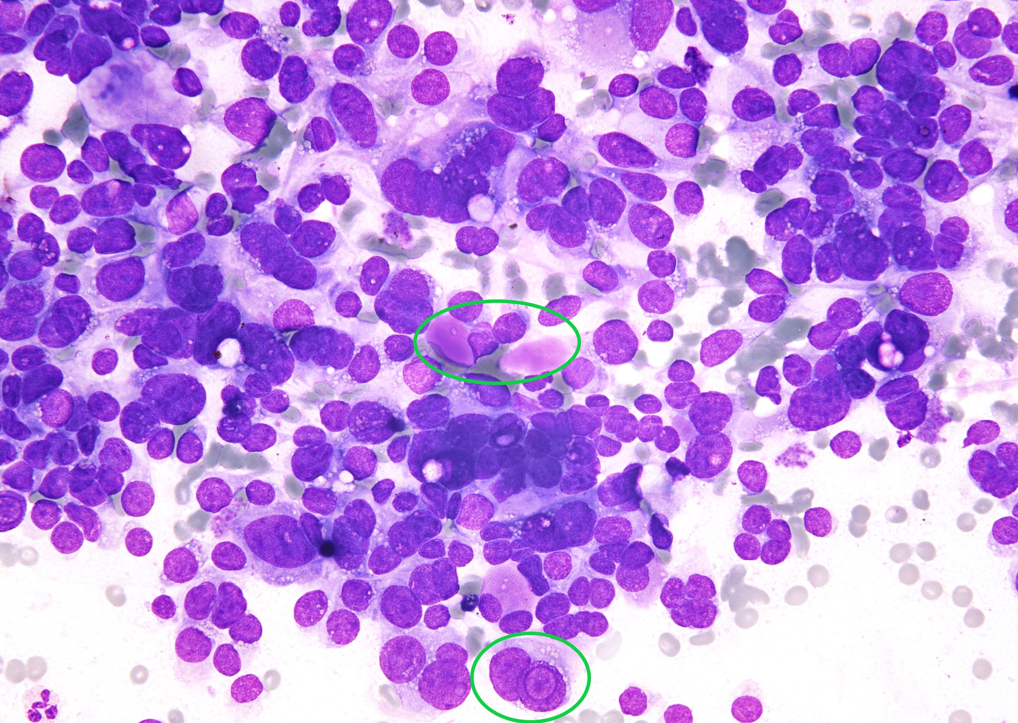 Medullary Carcinoma Amyloid