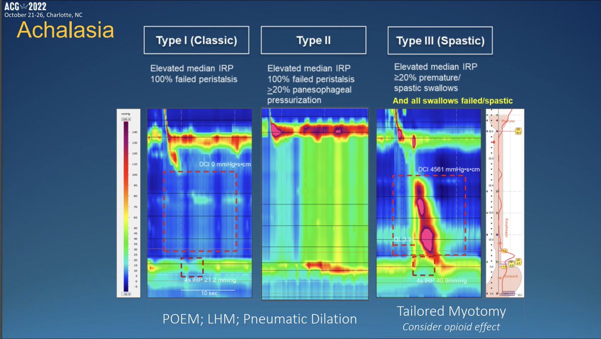 Non-#achalasia #motility disorders of the #esophagus with ...