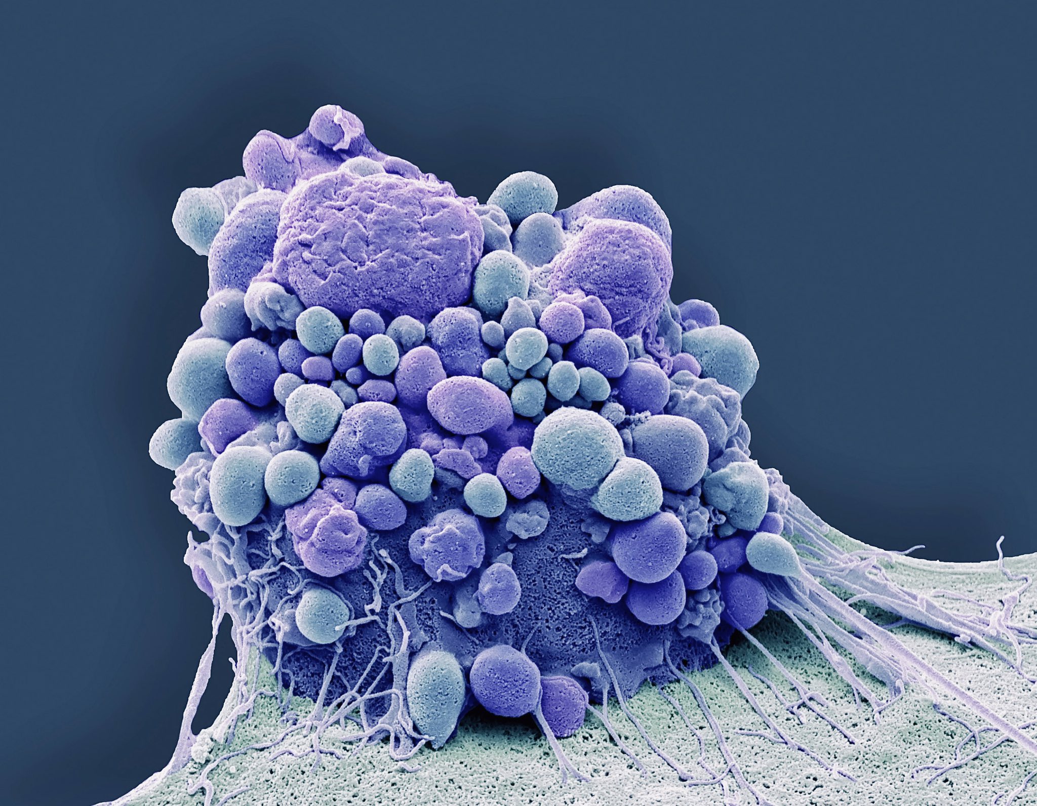 Cancer Cell Under Electron Microscope