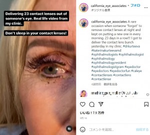 ライブドアニュース on Twitter: "1000RT：【驚き】女性の眼球からコンタクトレンズ24枚を取り除く アメリカ https://t.co/ZdL4iq4FAD 女性は最近忙しくし ...