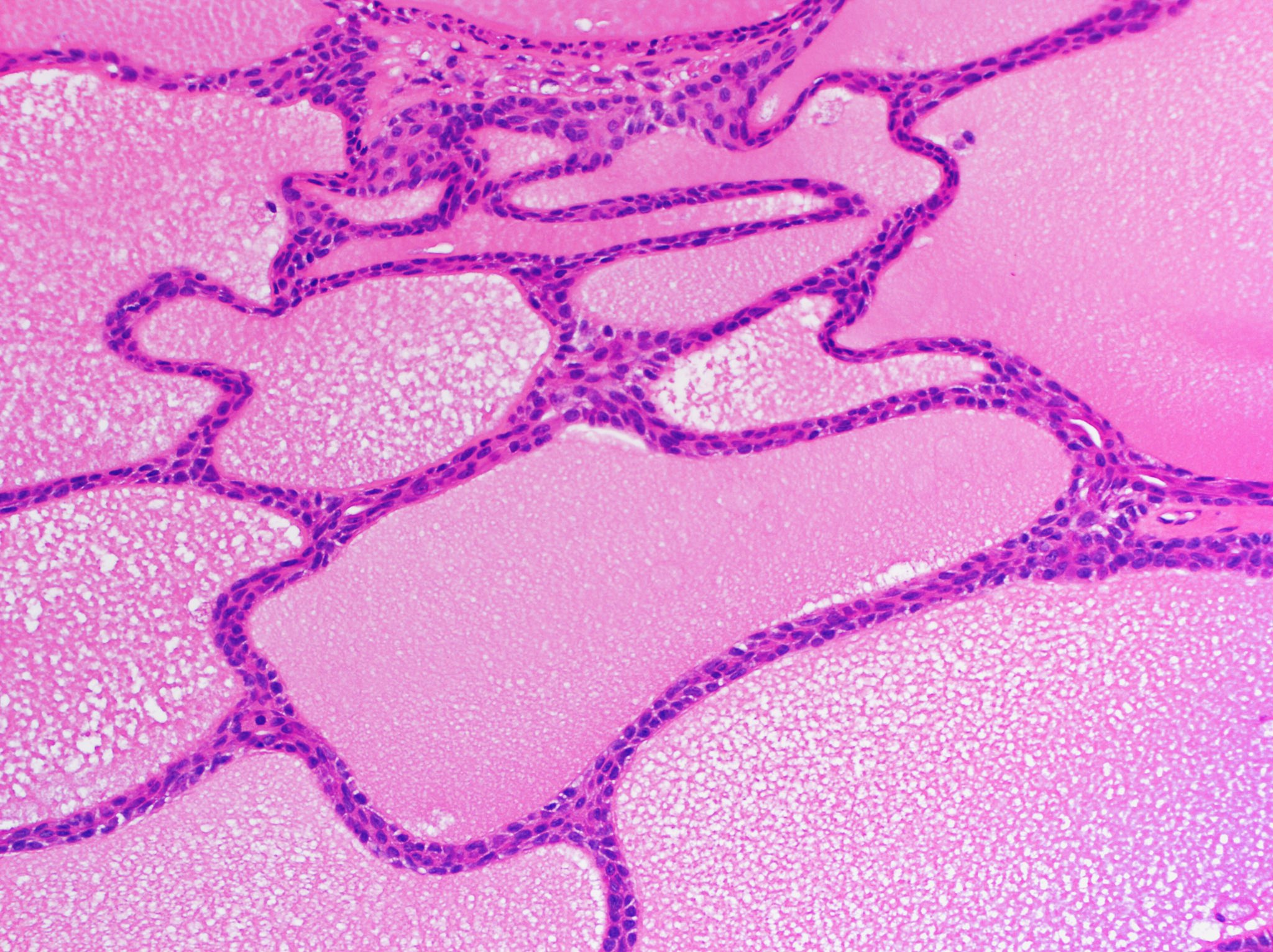 Multinodular Goiter Histology