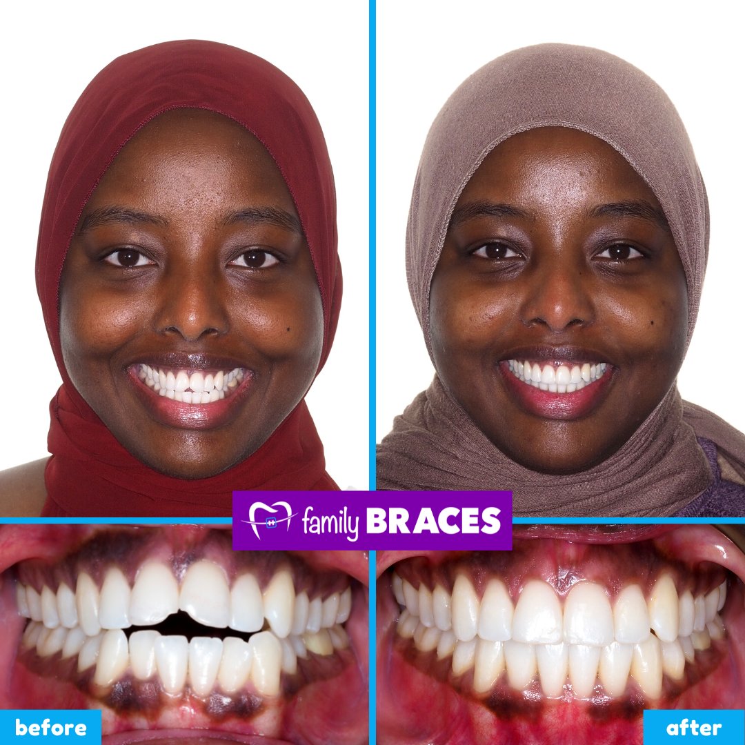 Invisalign Before And After Gap