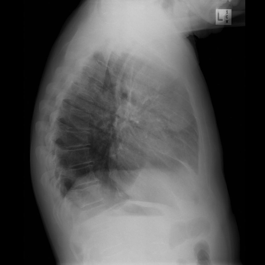 J Juxtaphrenic peak sign Tenting of the diaphragm that may be seen in ...