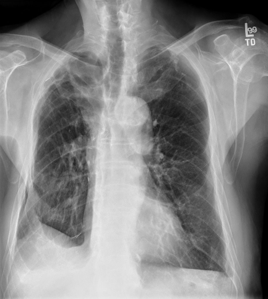 J Juxtaphrenic peak sign Tenting of the diaphragm that may be seen in ...
