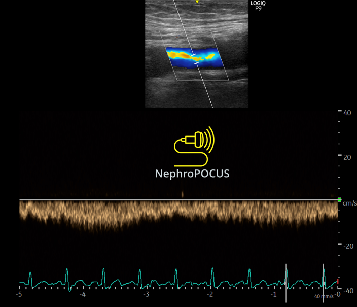 #VExUS #POCUS image of the day: Color Doppler of the Femoral vein ...