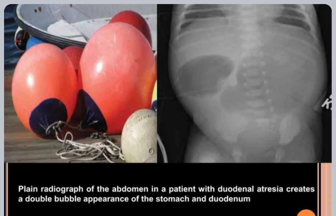 Annular Pancreas Double Bubble