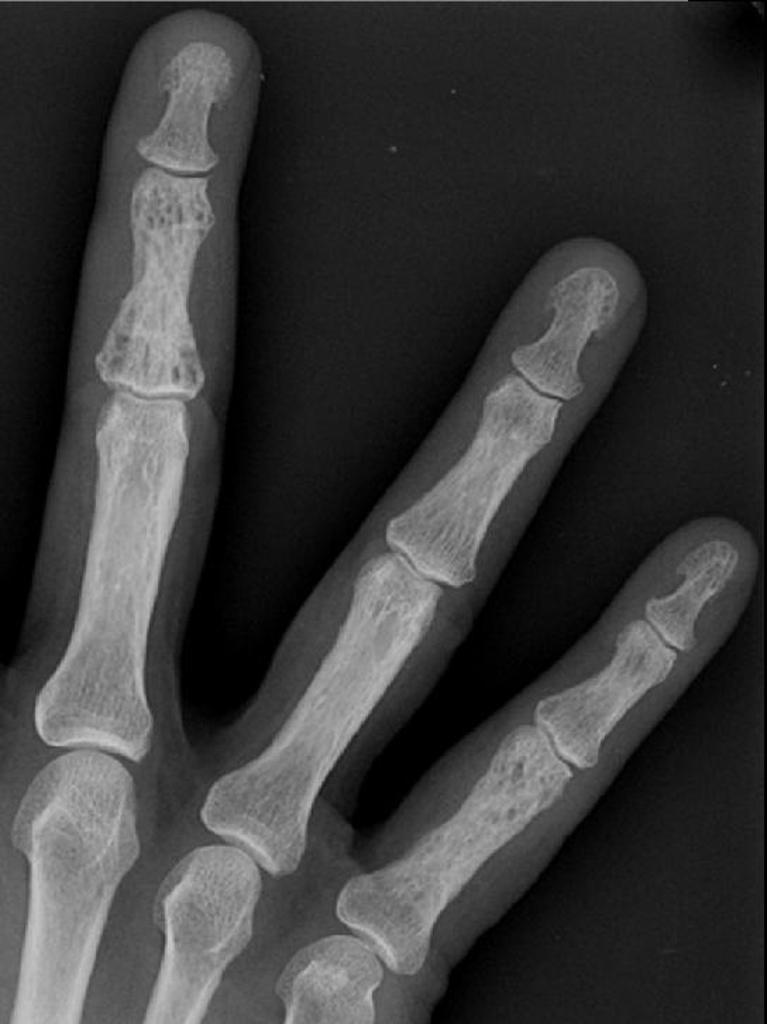 L Linguine sign MRI sign that may be seen in patients with ...