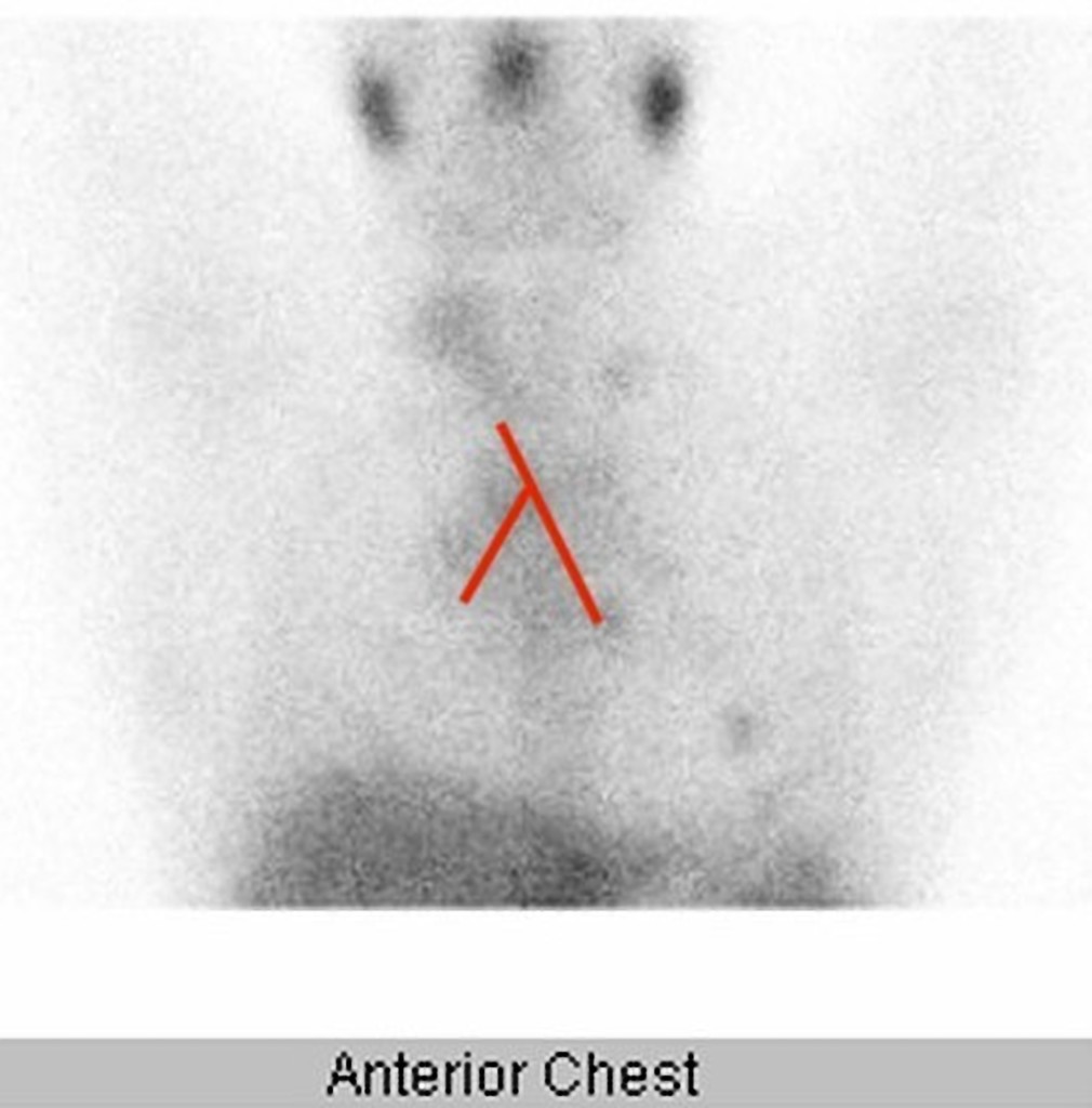 L Linguine sign MRI sign that may be seen in patients with ...