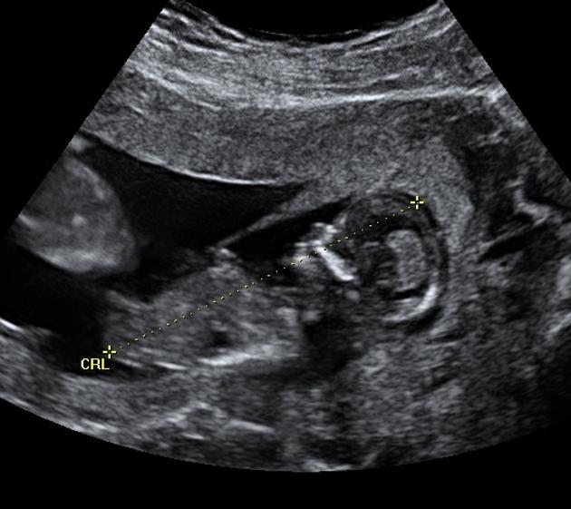 L Linguine sign MRI sign that may be seen in patients with ...