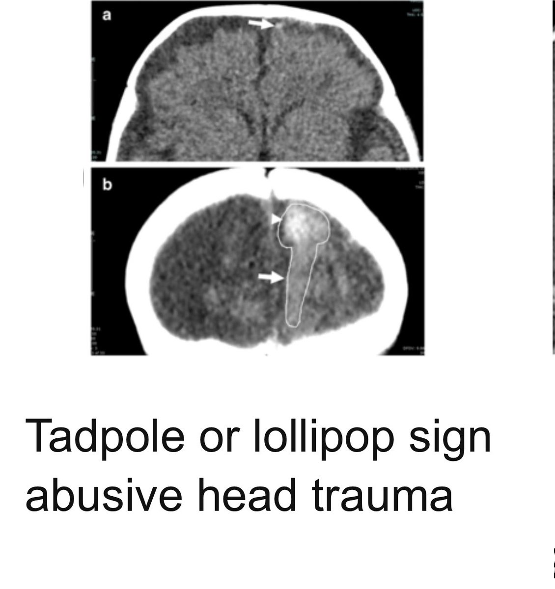 L Linguine sign MRI sign that may be seen in patients with ...