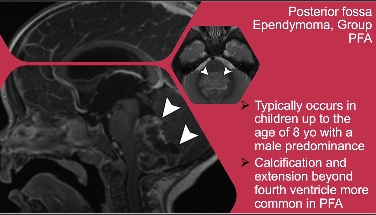 Get updated information on the 2021 WHO Classification of CNS Tumors by ...