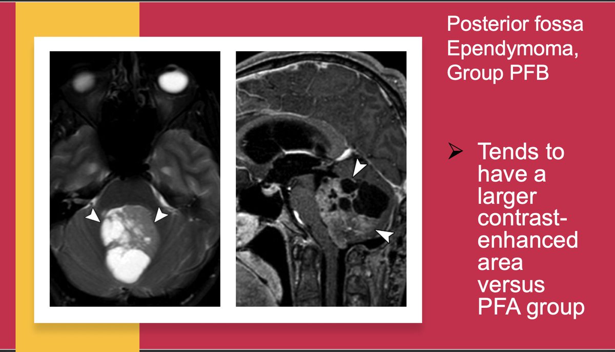 Get updated information on the 2021 WHO Classification of CNS Tumors by ...