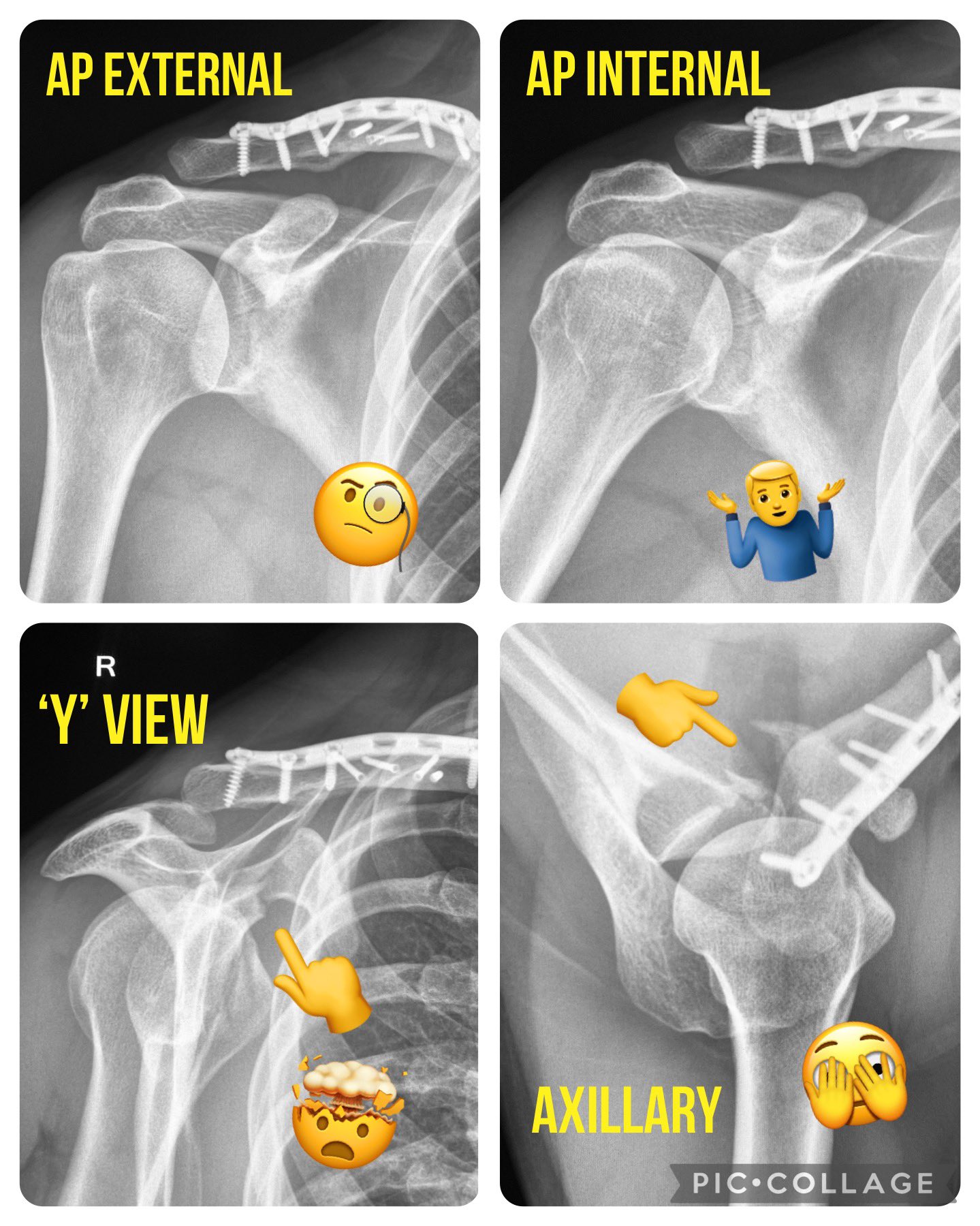 Shoulder Internal And External Rotation Effectiveness Of A Shoulder