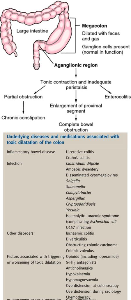 Toxic Megacolon C Diff