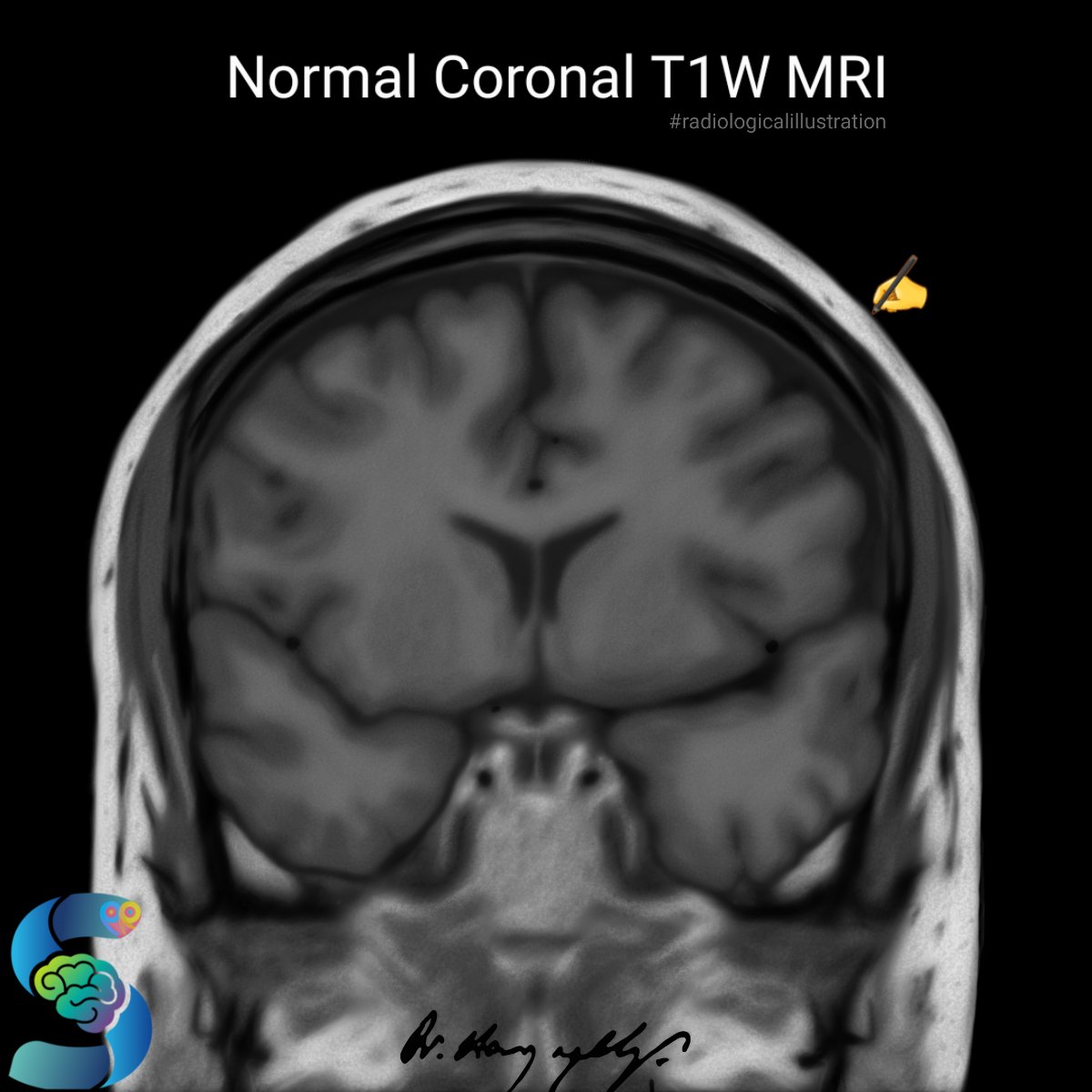 Normal Brain Mri Coronal
