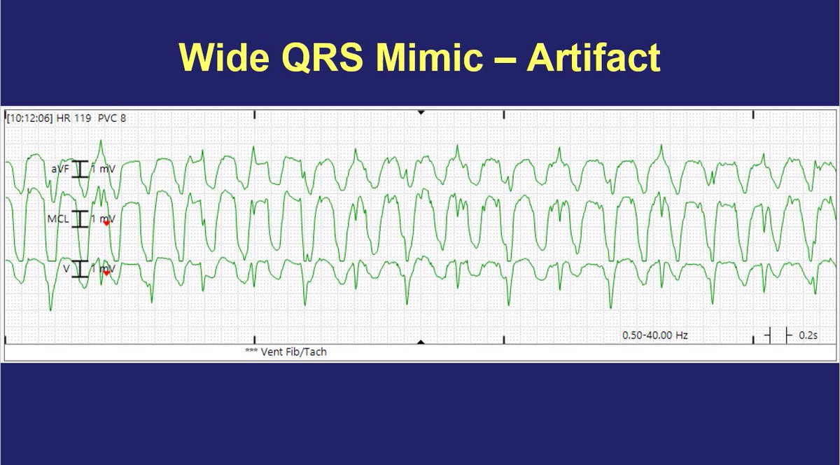 Fun presentation this weekend, to think about wide complex QRS ...