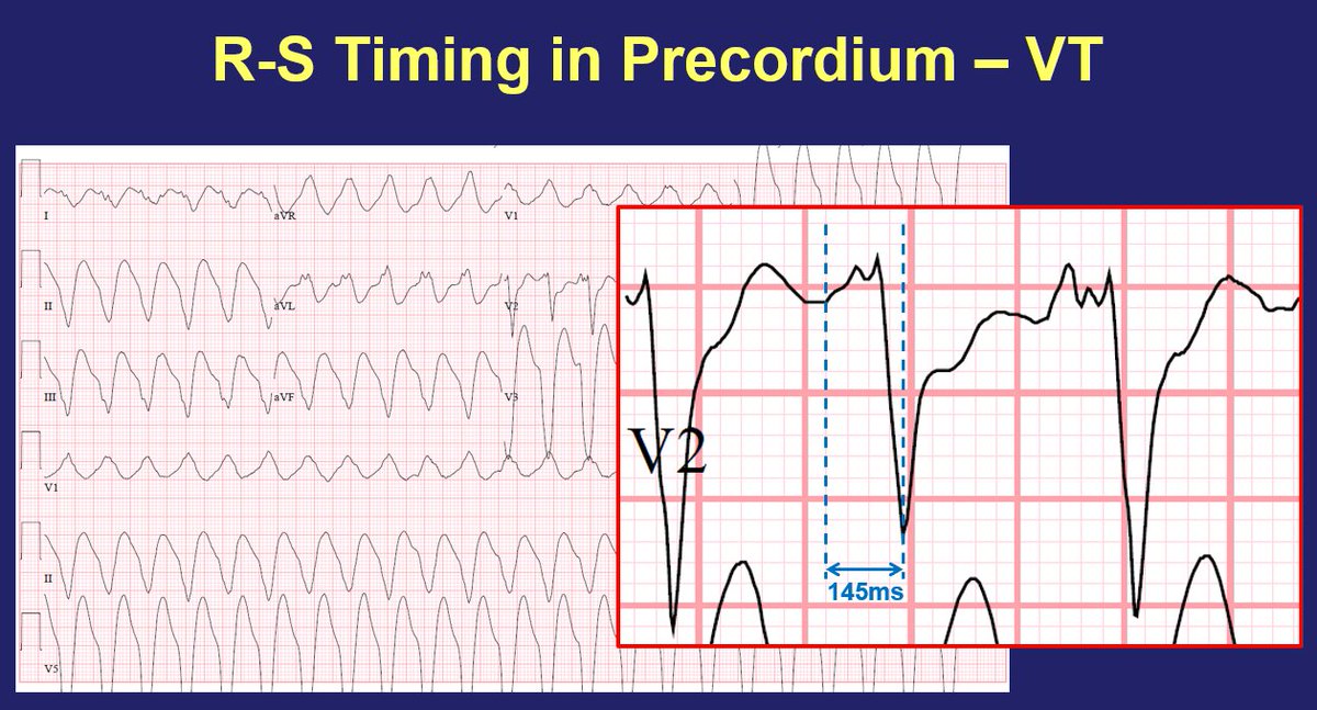 Fun presentation this weekend, to think about wide complex QRS ...