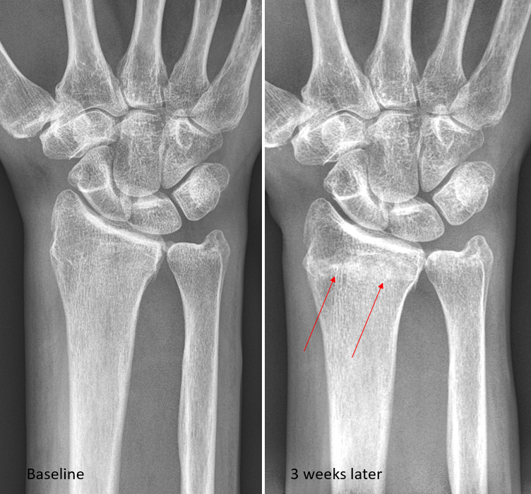 Gopal Punjabi On Twitter Value Of Follow Up Xrs When Not Sure Of Fracture Sclerosis In The
