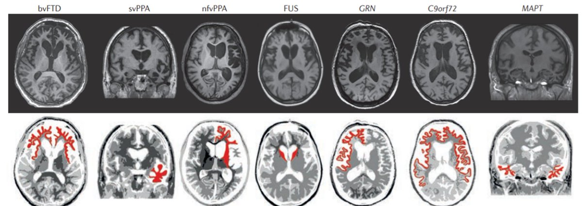 Frontotemporal dementia: spectrum, criteria and clinical peculiarities ...