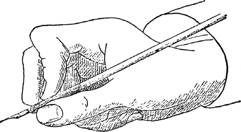 Movement Disorders – Dystonia (Writer's cramp) “abnormal postures and ...