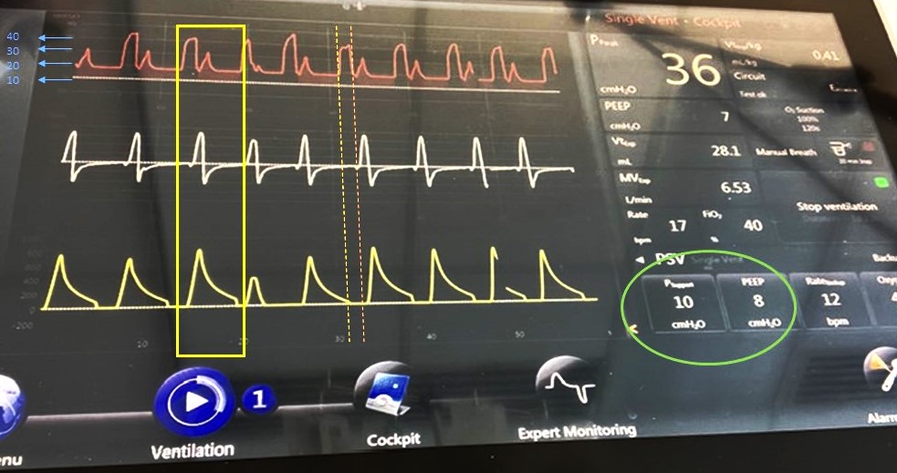 Mechanical Ventilator Screen