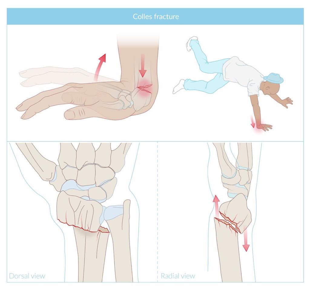 السقوط على يد ممدودة أو FOOSH (Fall on out stretched hand) يعد من أكثر ...