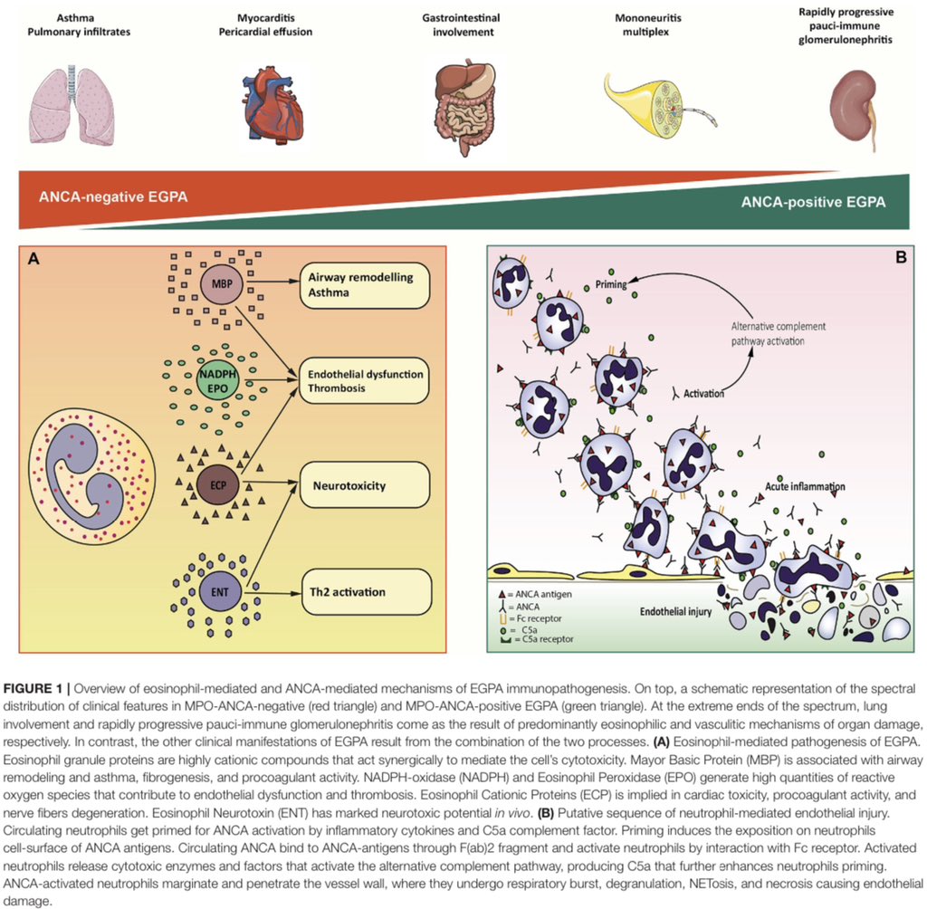 Mauricio Ambriz on Twitter: "RT @CMNO_MedInt: Artículo de revisión: Granulomatosis eosinofílica ...