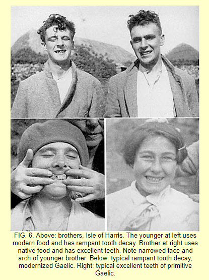 How to remineralize your teeth. A thread. - المسلسل من George Ferman ...