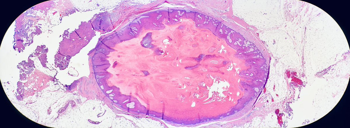 Chondroblastoma Chicken Wire