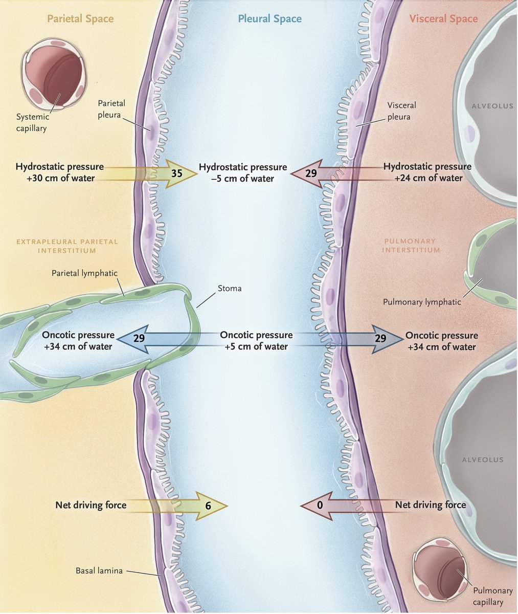 🫁💧 Pleural Effusion Schema 💧🫁 1) Thoracentesis → Calculate Light's ...
