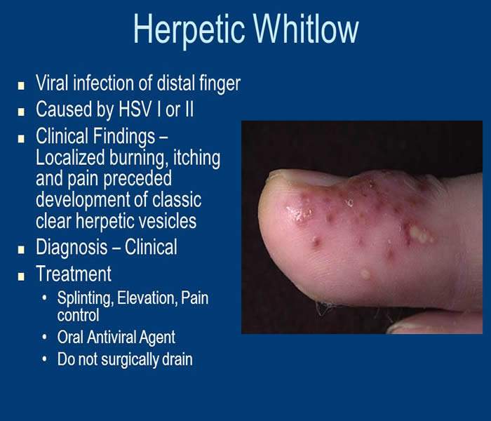 Herpetic Whitlow Finger Treatment