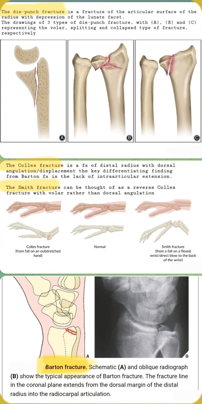 Reverse Colles Fracture Colles Fracture A Common Wrist Fracture
