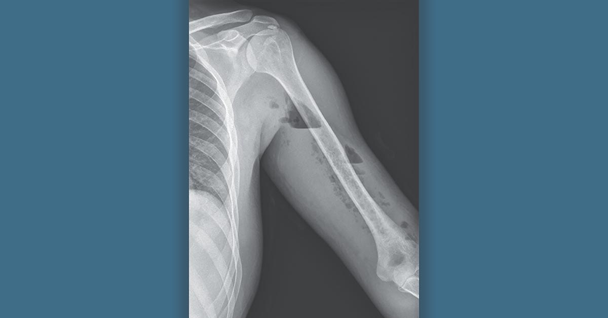 NEJM on Twitter: "A 37-year-old man presented with a 1-week history of pain and swelling in the ...