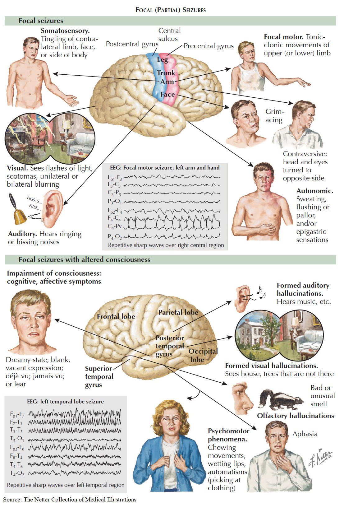 Partial Seizure Brain