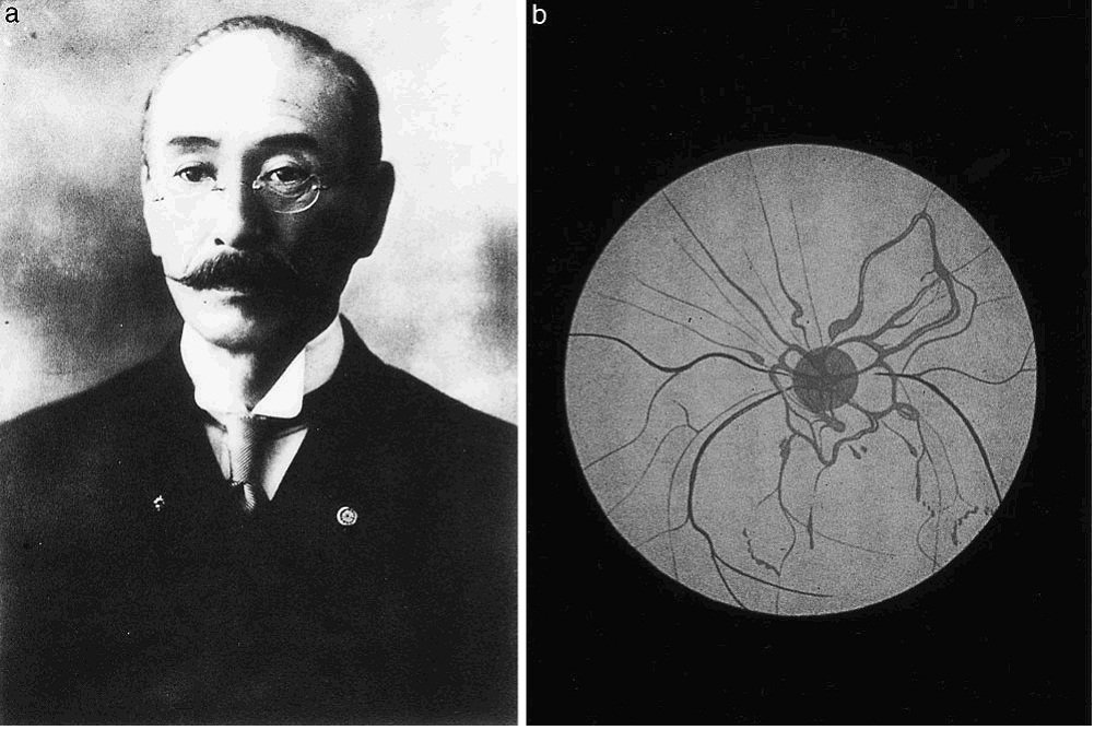 1/n Here is a thread on TAKAYASU ARTERITIS , aka PULSELESS DISEASE ...