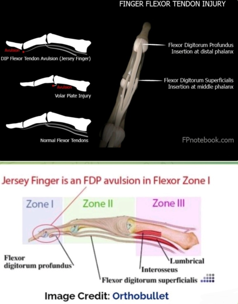 Flexor Digitorum Profundus Tendon