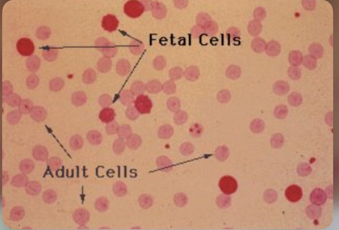 سمعتم قبل عن تحليل Kleihauer-Betke Test ؟ 👀 اذا لا ركزوا معاي وخلونا ...