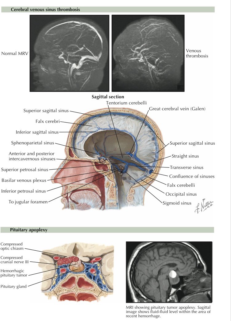 Great Cerebral Vein