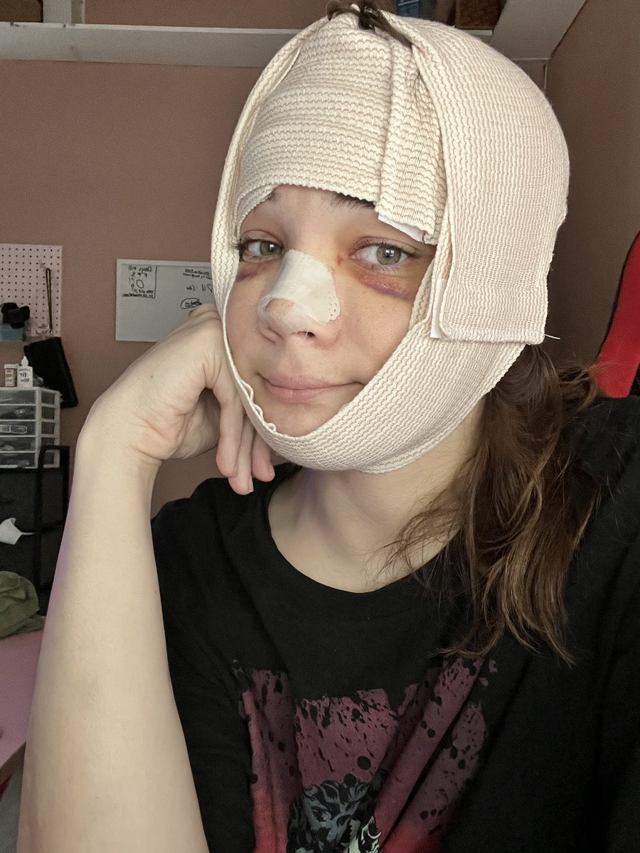 AddieLove on Twitter: "Still pretty swollen but I love the results so far especially my side ...