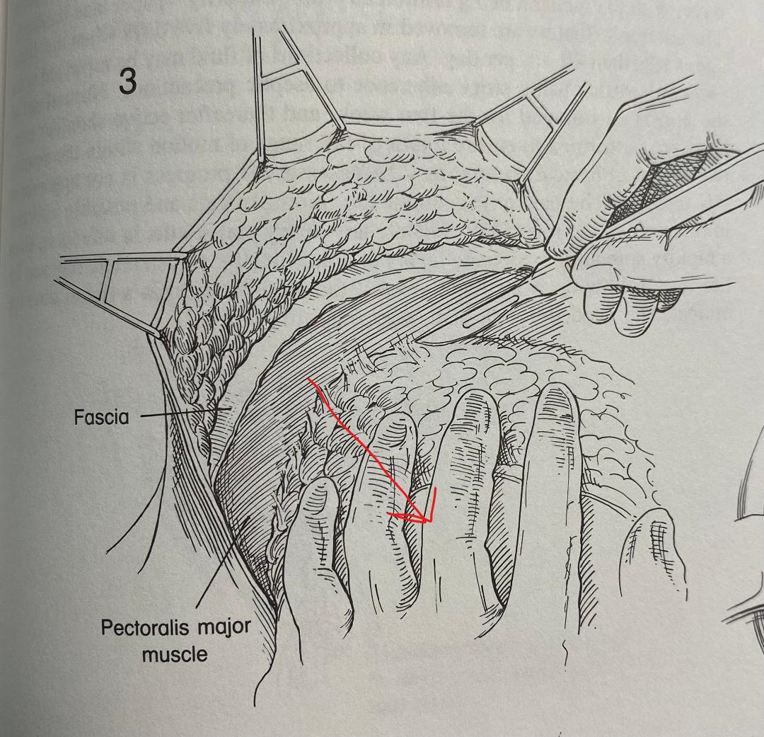 🧵regarding the principles of 'traction' and 'countertraction'. These ...