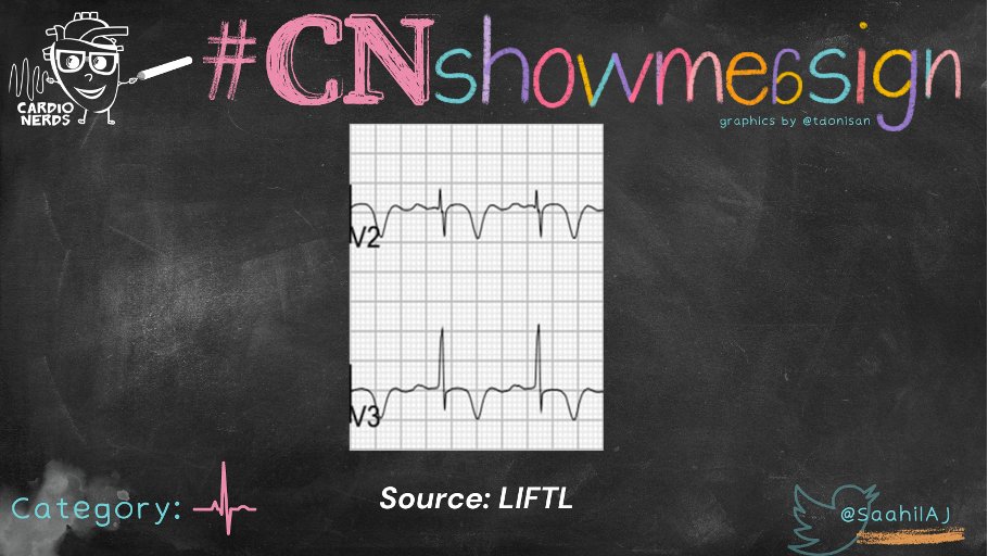 Well, well, well – look what we have here. What does this sign on EKG ...