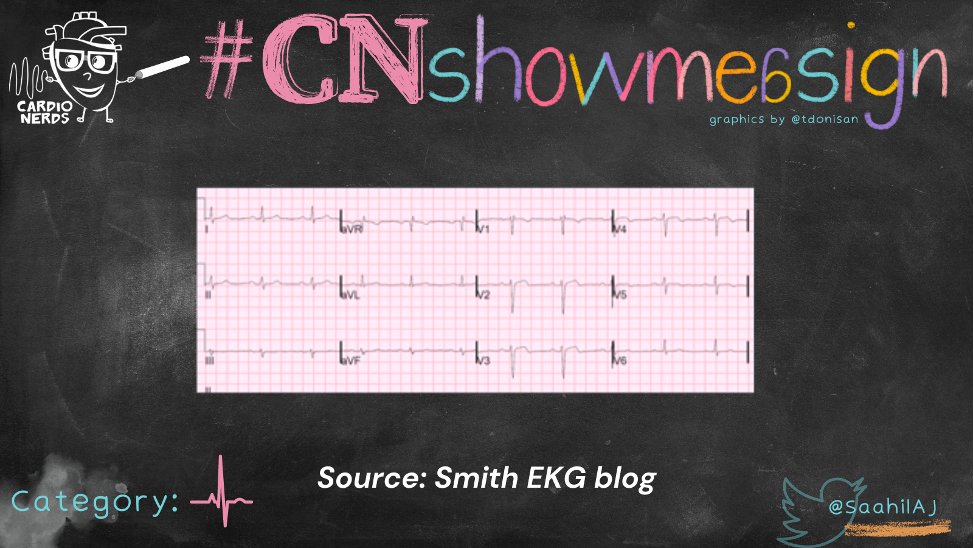 Well, well, well – look what we have here. What does this sign on EKG ...