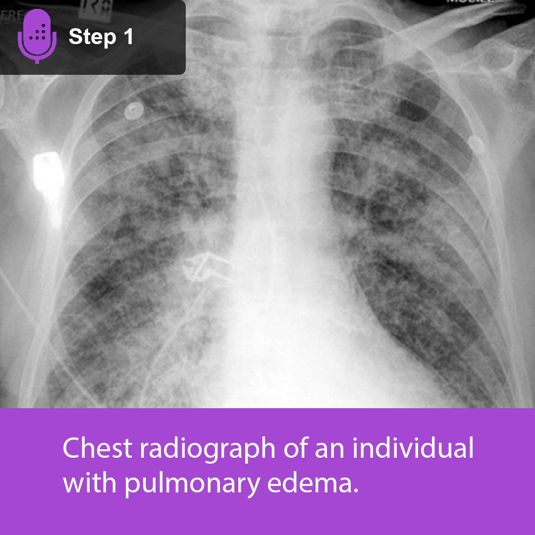 Chest X Ray Pulmonary Edema 🔴Chest X Ray In Heart Failure 🔹The