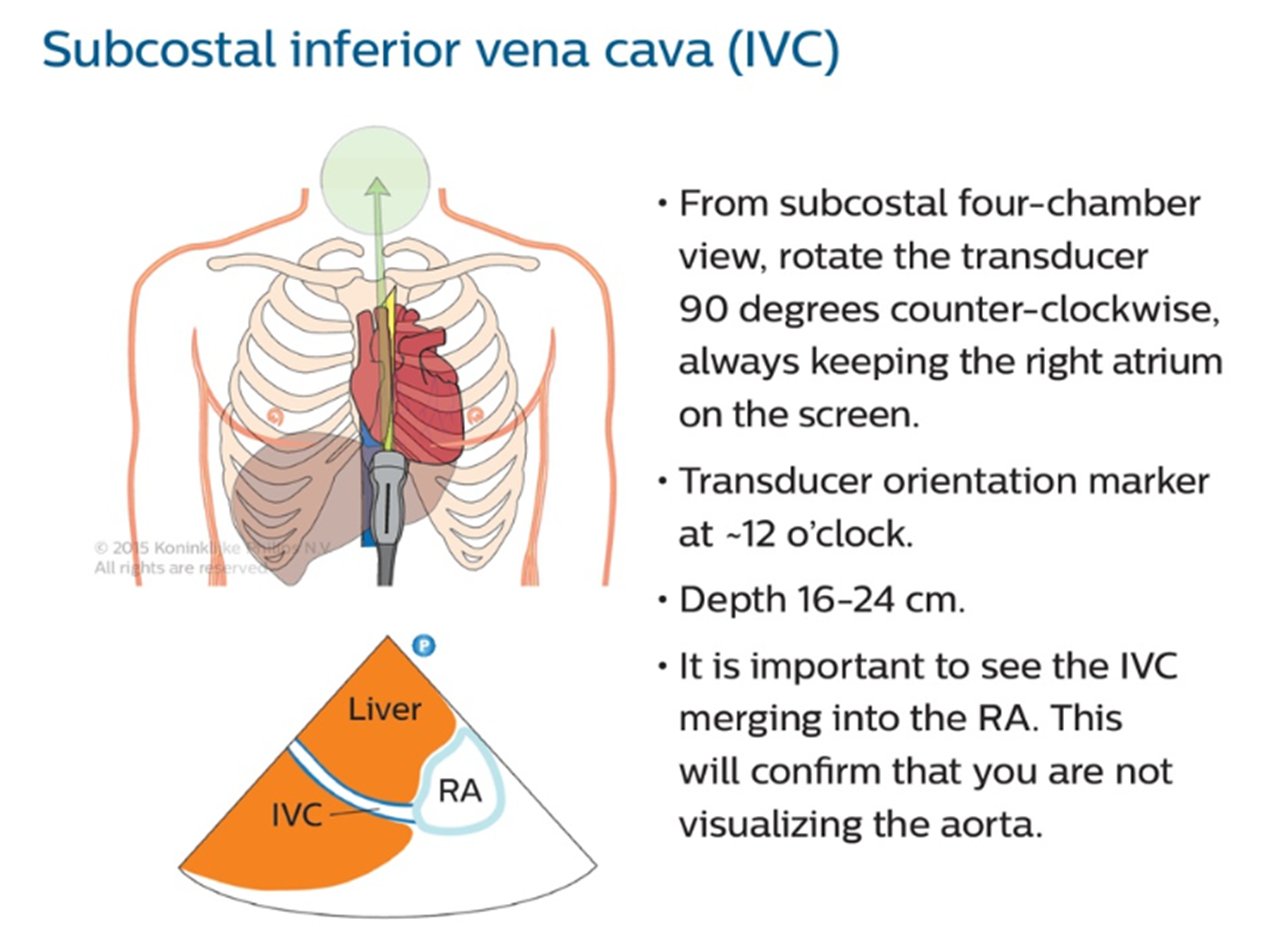 Counting Intercostal Spaces