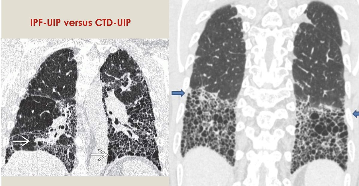 3 signs can discriminate between UIP due to connective tissue disease ...